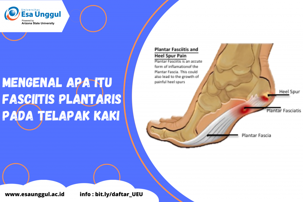 Mengenal Apa Itu Fasciitis Plantaris Pada Telapak Kaki – Fakultas ... Mengenal Apa Itu Fasciitis Plantaris Pada Telapak Kaki – Fakultas ...